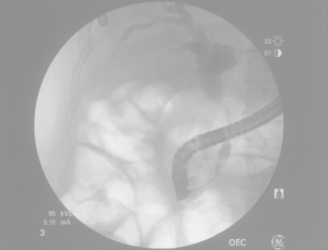 ercp - Differential Diagnosis of