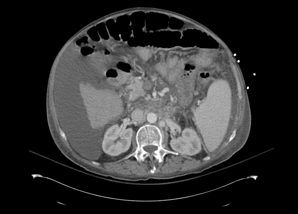 PVT CT A/P Thumbnail - Differential Diagnosis of