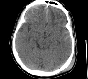 ct_head - Differential Diagnosis of