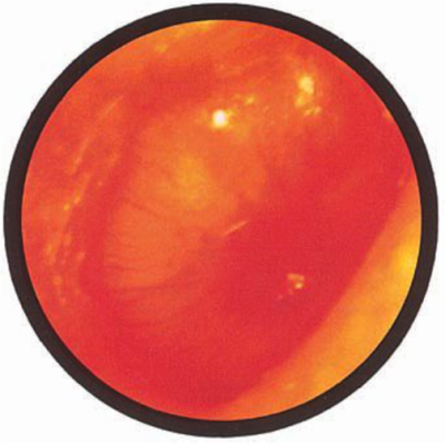 Acute Otitis Media - Differential Diagnosis of