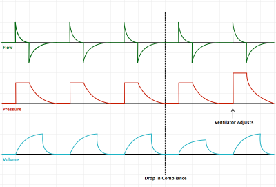 Pressure-Regulated Volume Control (PRVC) - Differential Diagnosis of