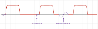 Synchronized Intermittent Mandatory Ventilation (SIMV) - Differential ...