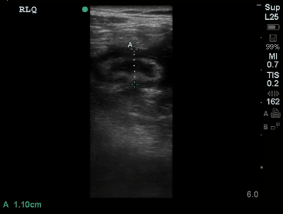 Appendicitis - Differential Diagnosis of