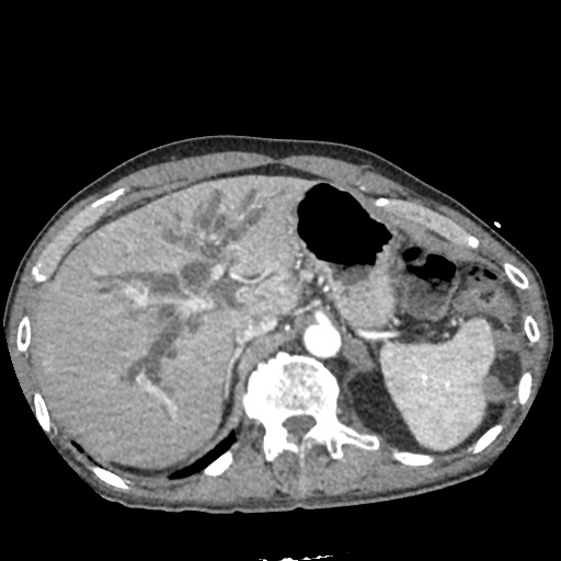 Differential Diagnosis of Biliary Duct Dilation