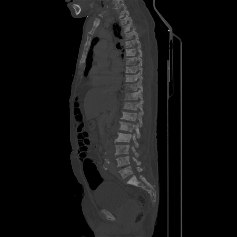 ct_bone_anemia_06 - Differential Diagnosis of