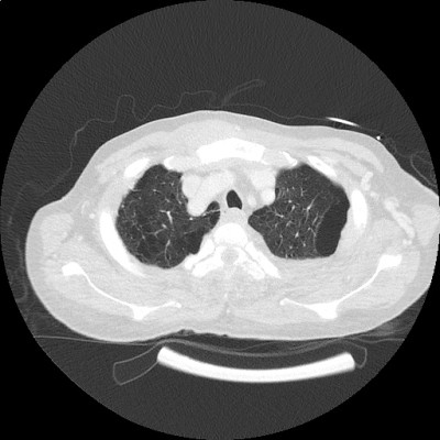 ct_chest_anemia_01 - Differential Diagnosis of
