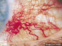 Differential Diagnosis of Conjunctivitis and the Red Eye