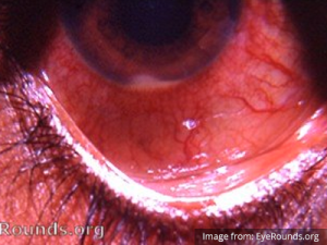 Differential Diagnosis of Conjunctivitis and the Red Eye