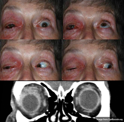 Orbital Pseudotumor - Differential Diagnosis of