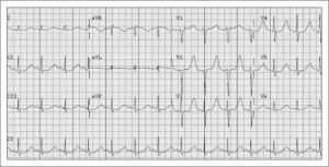 ECG: U-wave - Differential Diagnosis of