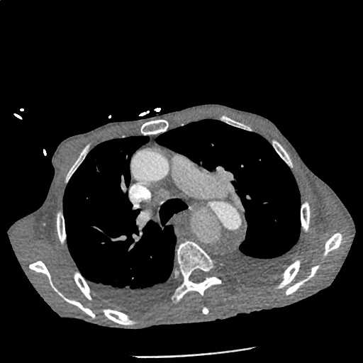 Differential Diagnosis of Aortic Dissection