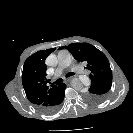 Differential Diagnosis of Aortic Dissection