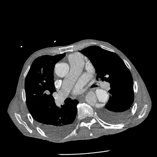 Differential Diagnosis of Aortic Dissection