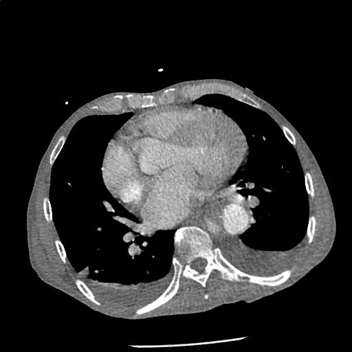 Differential Diagnosis of Aortic Dissection