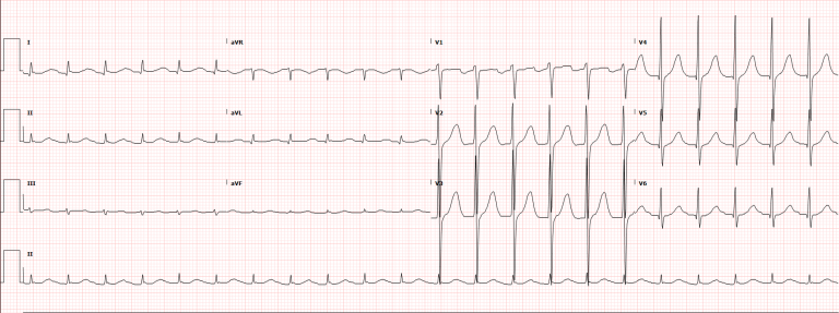 Baseline ECG - Differential Diagnosis of