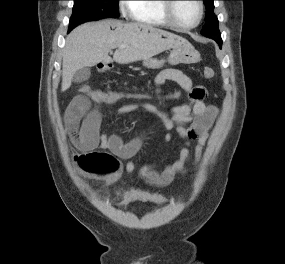 Differential Diagnosis of Portal Venous Gas