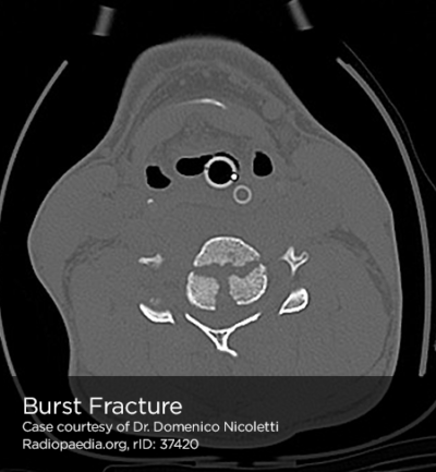 Burst Fracture - Differential Diagnosis of