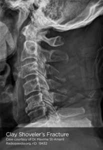 Clay Shoveler's Fracture - Differential Diagnosis of
