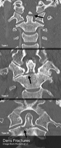 Dens Fractures - Differential Diagnosis of