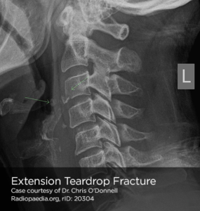 Extension Teardrop Fracture - Differential Diagnosis of