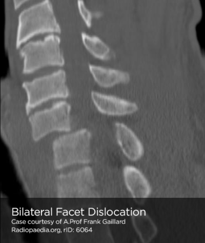 Bilateral Facet Dislocation - Differential Diagnosis of