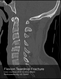 Flexion Teardrop Fracture - Differential Diagnosis of