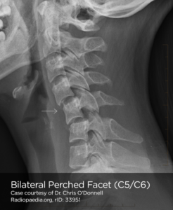 Bilateral Perched Facet - Differential Diagnosis of