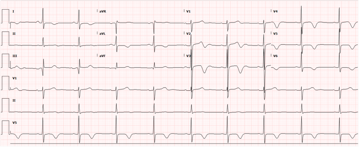 Differential Diagnosis of Wellens Syndrome