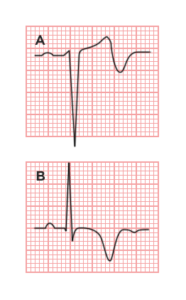 Differential Diagnosis of Wellens Syndrome