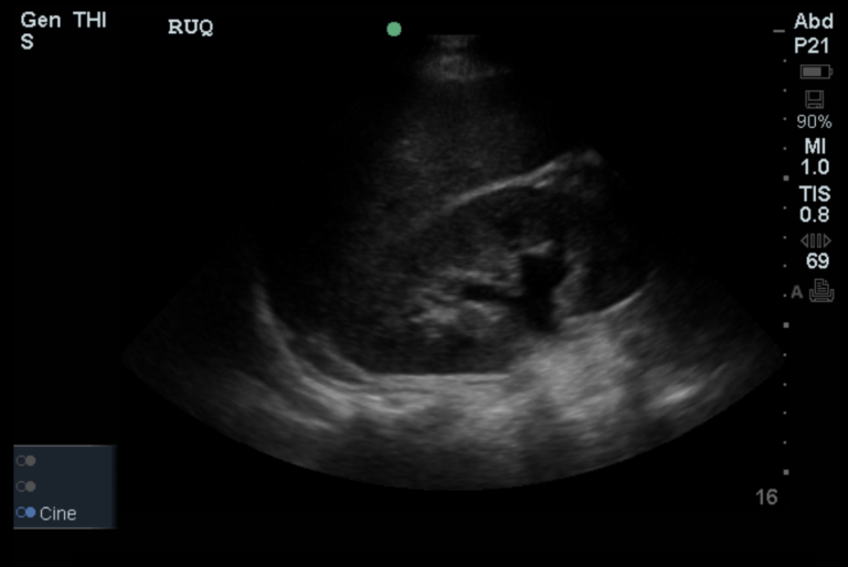 RUQ - Differential Diagnosis of