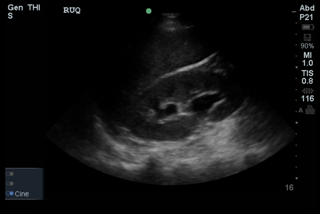RUQ - Differential Diagnosis of