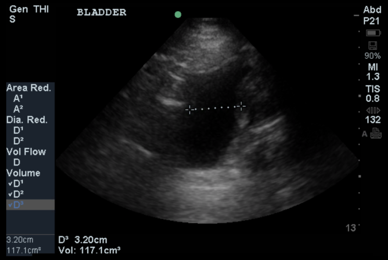Bladder Volume - Differential Diagnosis of