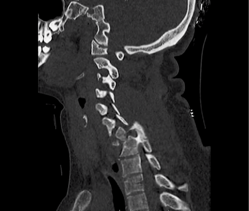 c-spine_02 - Differential Diagnosis of