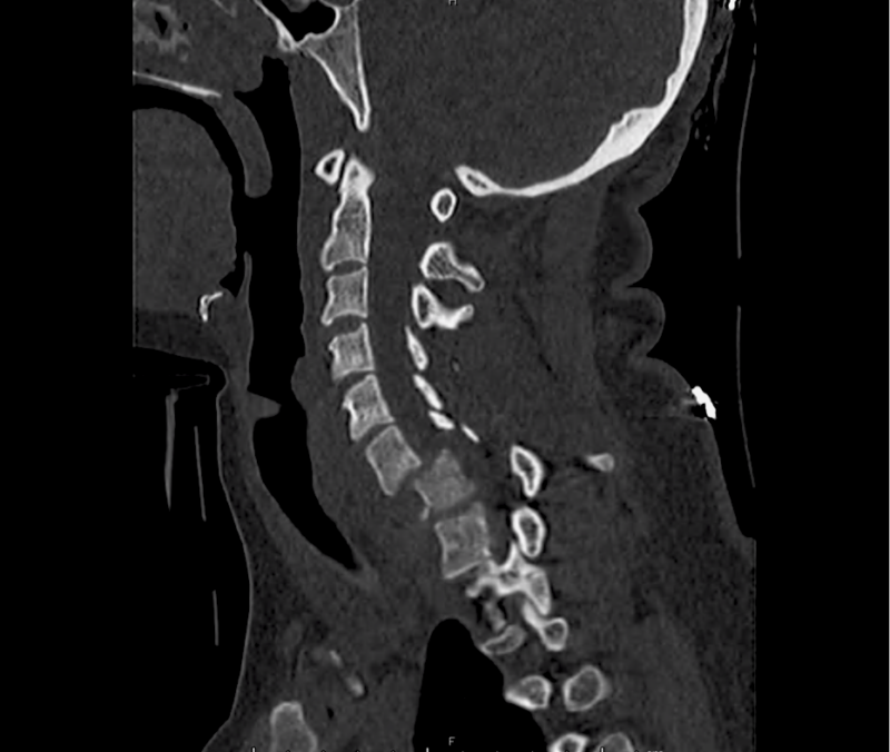 c-spine_11 - Differential Diagnosis of