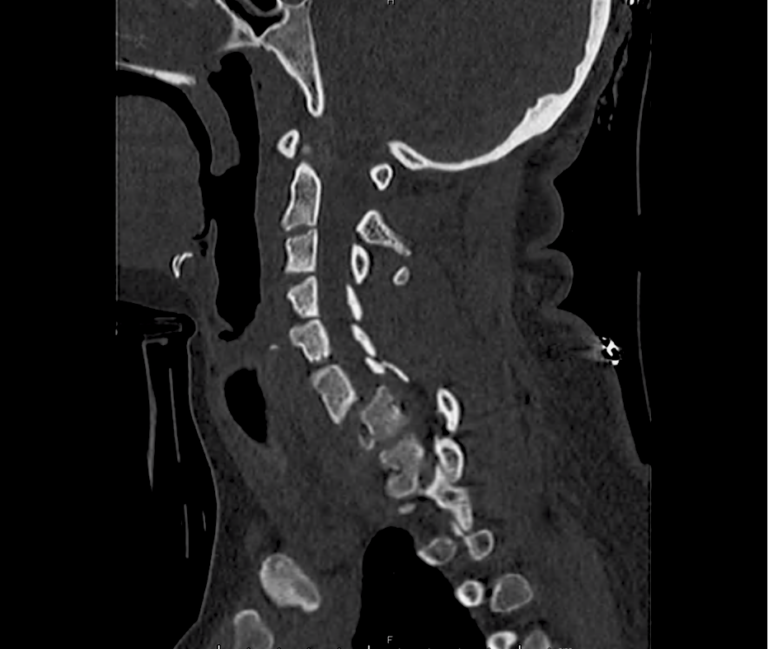 c-spine_12 - Differential Diagnosis of