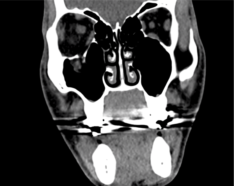 entrapment_6 - Differential Diagnosis of