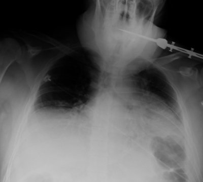 Differential Diagnosis of Penetrating Neck Trauma