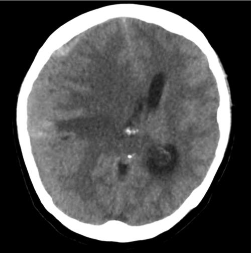 ct-mass_14 - Differential Diagnosis of