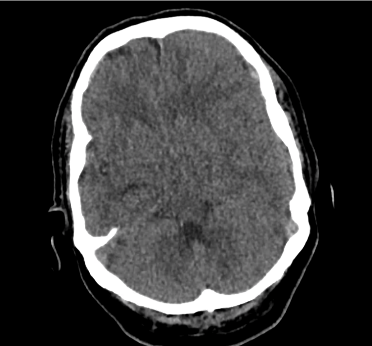 ct-sdh_04 - Differential Diagnosis of