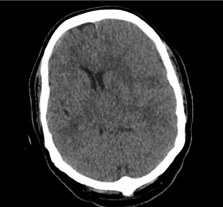 ct-sdh_06 - Differential Diagnosis of