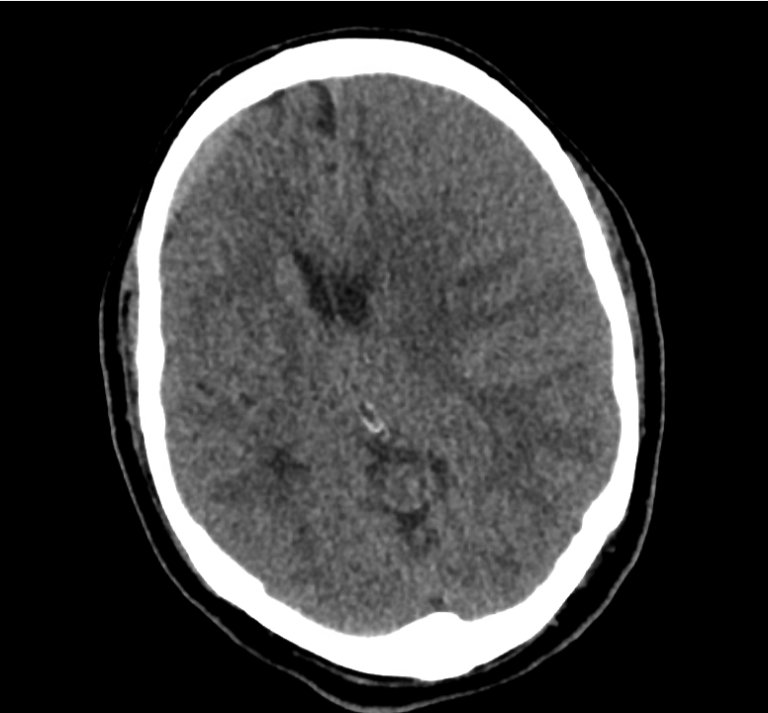 ct-sdh_08 - Differential Diagnosis of