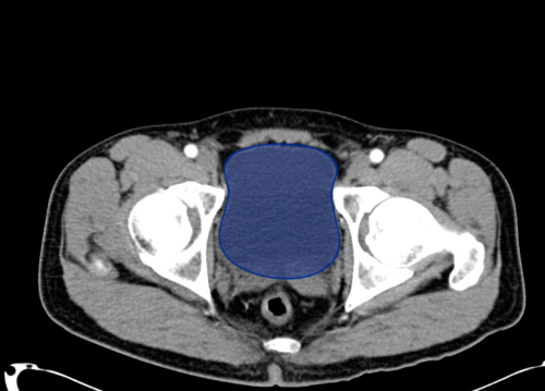 Ct0014solidbladder Differential Diagnosis Of