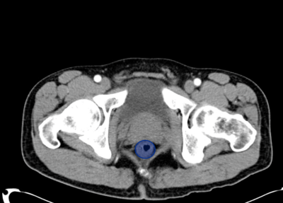 ct_0015_bowel_rectum - Differential Diagnosis of