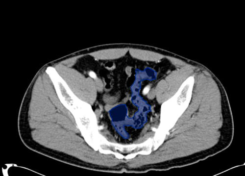 Ct0016bowelsigmoid Differential Diagnosis Of