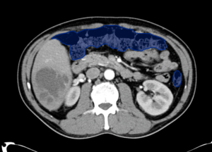 ct_0017_bowel_transverse - Differential Diagnosis of