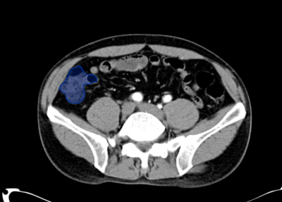 ct_0018_bowel_cecum - Differential Diagnosis of