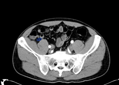 ct_0019_bowel_appendix - Differential Diagnosis of