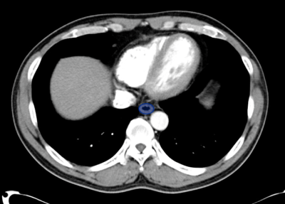 ct_0022_bowel_esophagus - Differential Diagnosis of