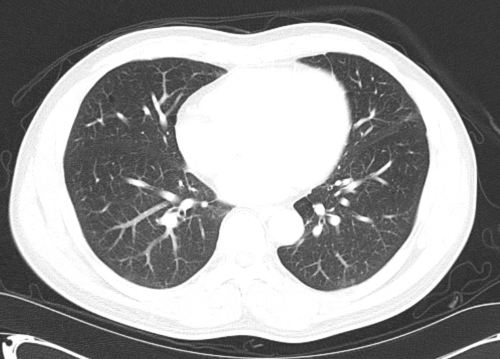 ct_0023_lung_window - Differential Diagnosis of