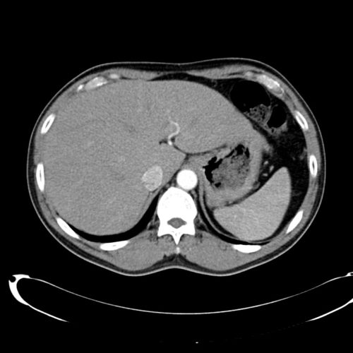 ct_annotation_04 - Differential Diagnosis of